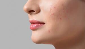 Non-Toxic Skincare For Post-Acne Red Spots (PIE) - Umbel Organics